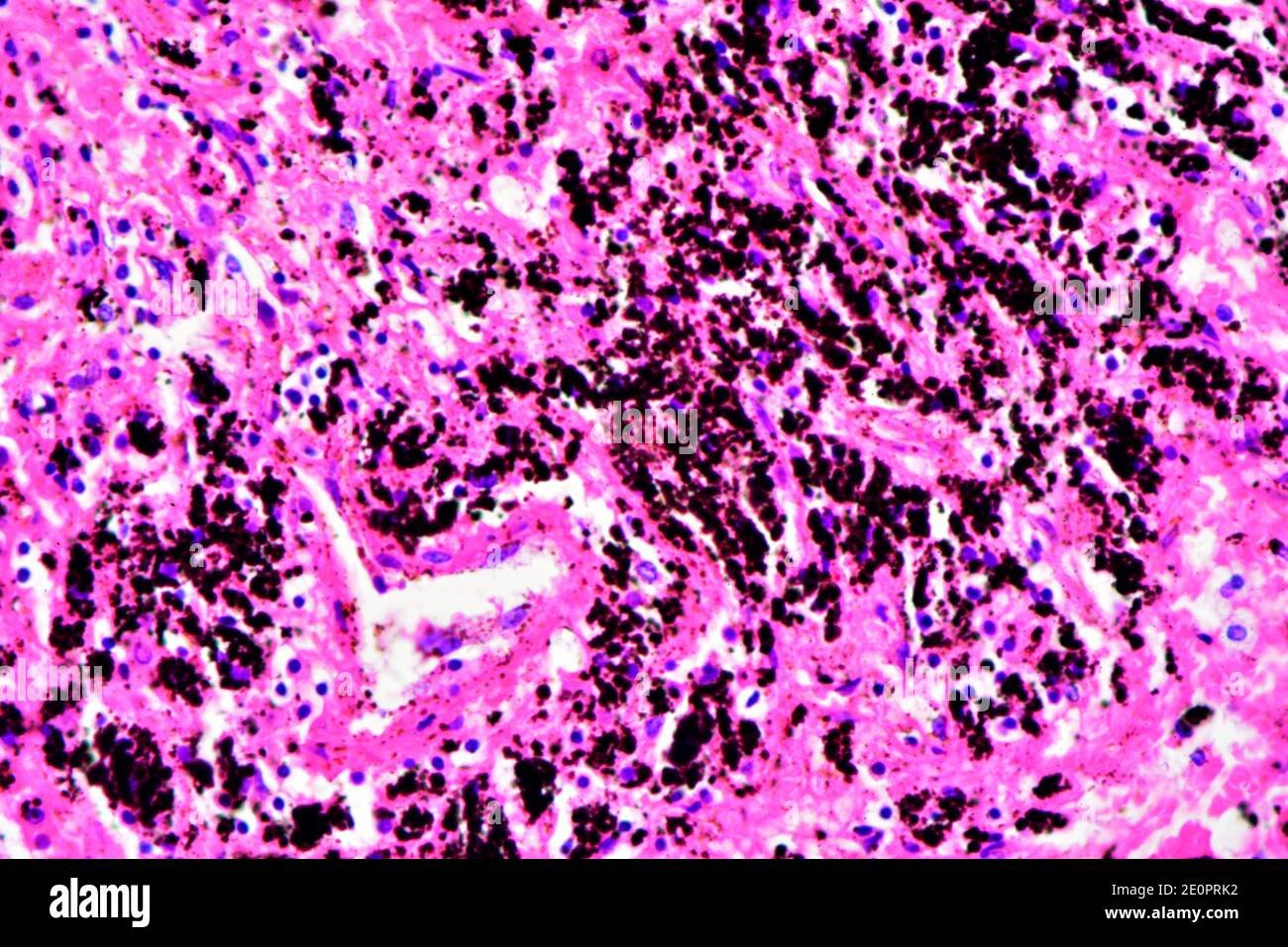 Black lung disease hi-res stock photography and images - Alamy