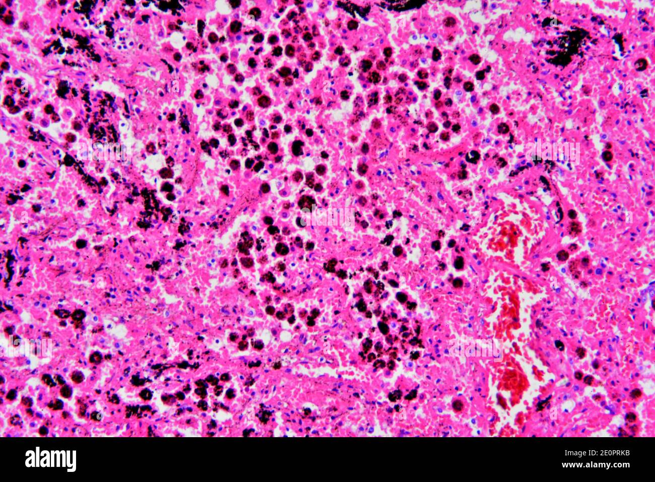 Black Lung Disease High Resolution Stock Photography and Images - Alamy