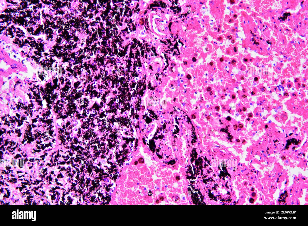 Black lung disease hi-res stock photography and images - Alamy