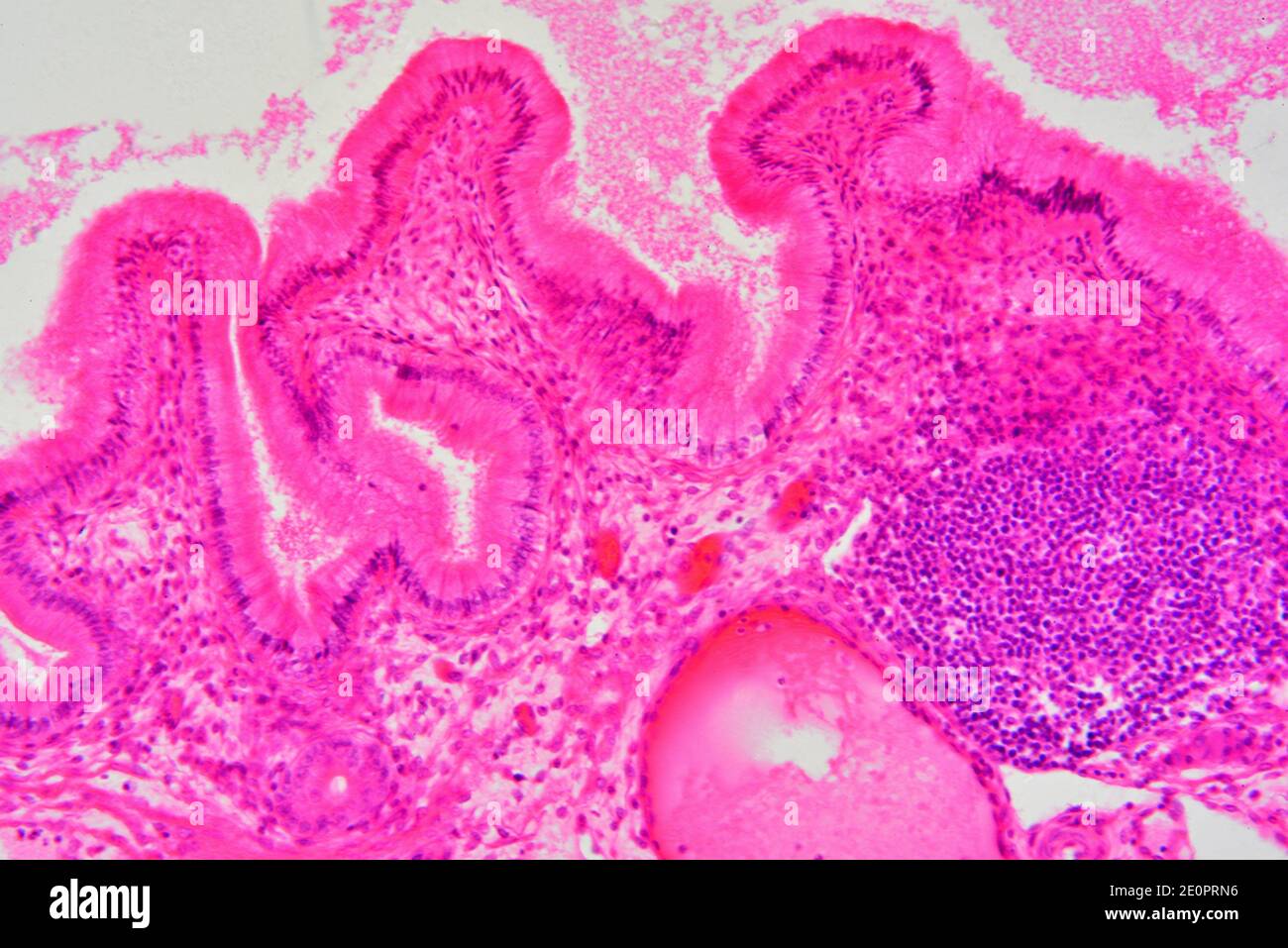 Simple Columnar Epithelium Gallbladder