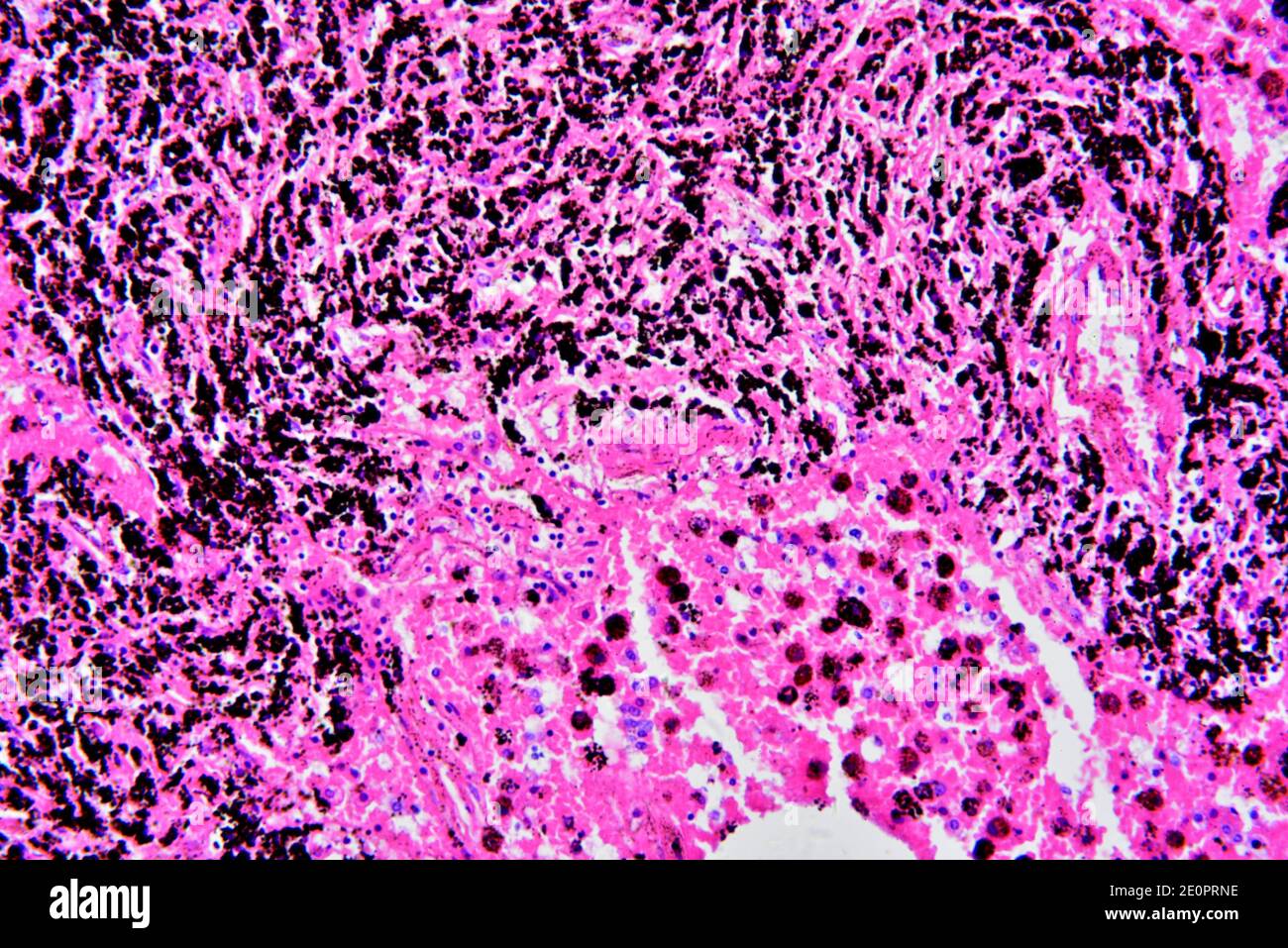 Black Lung Disease High Resolution Stock Photography and Images - Alamy