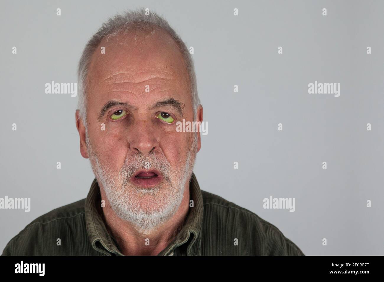 Drug side effects. An older man with drooping and pale green eyes in ...