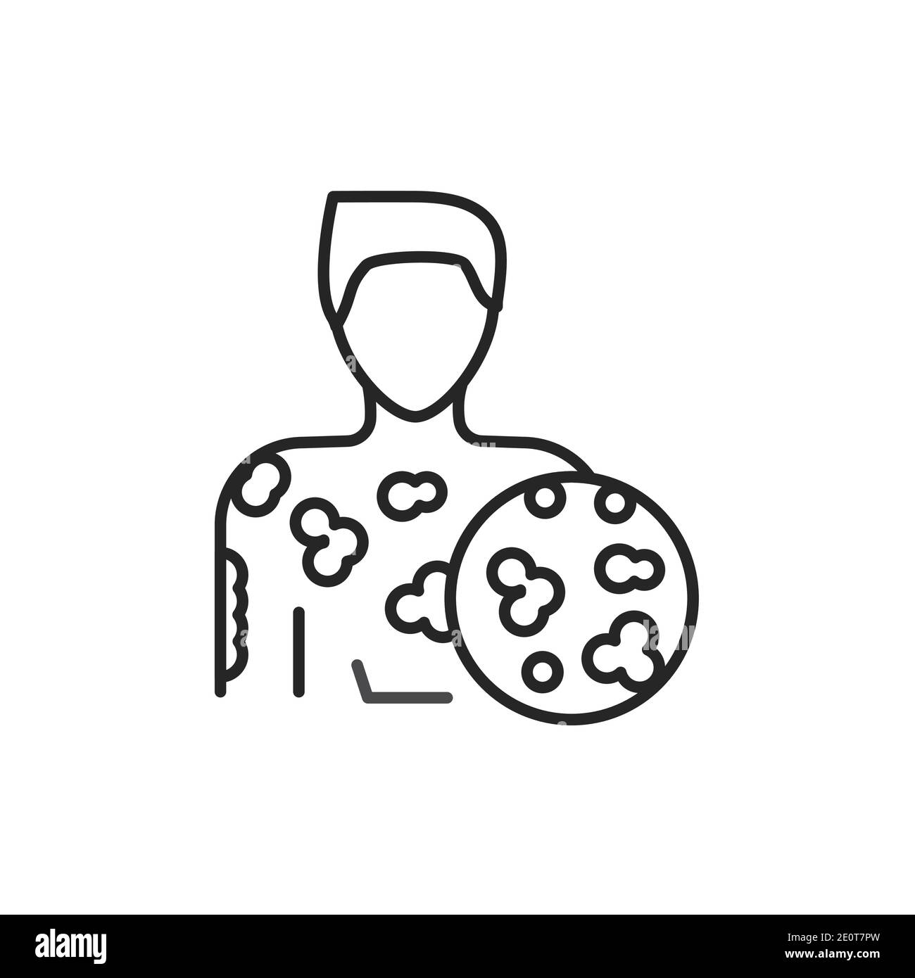 Urticaria illustration Black and White Stock Photos & Images - Alamy