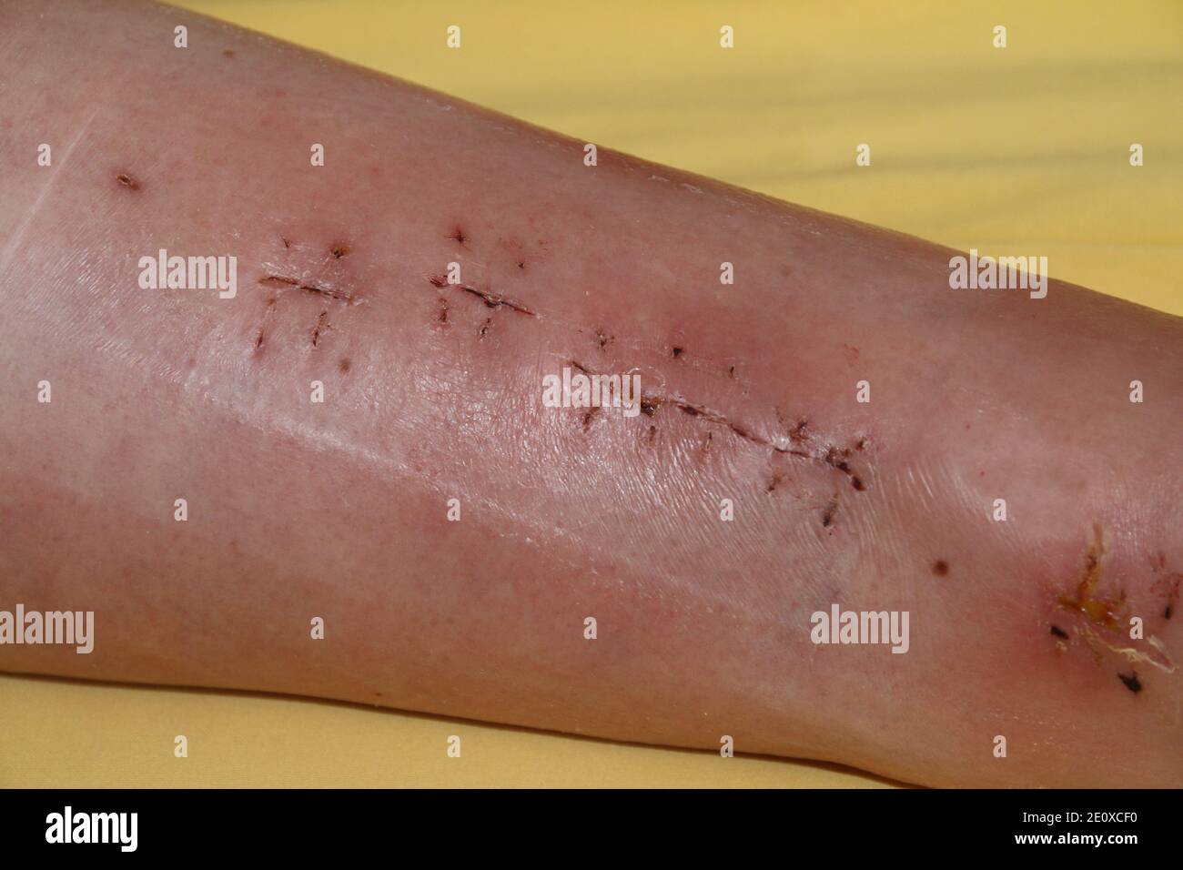 Scar After Surgical Treatment Stock Photo - Alamy