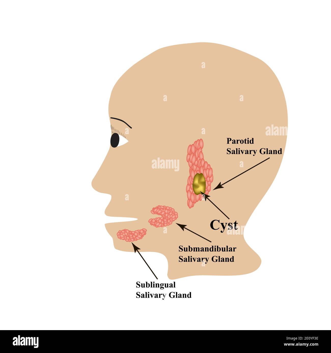 Sublingual Gland Cyst