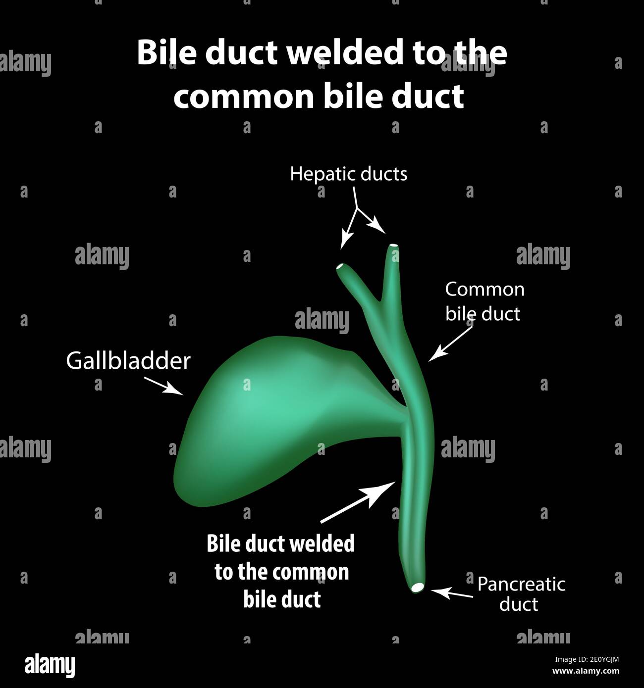 Bile duct welded to the common bile duct. Pathology of the gallbladder ...