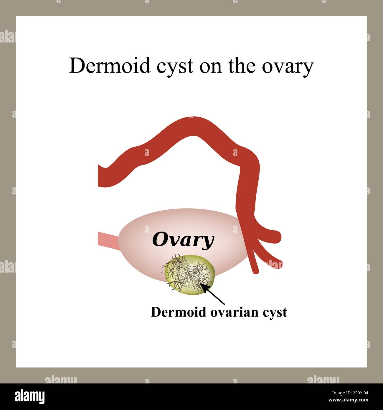 Dermoid Cyst Ovary Eye