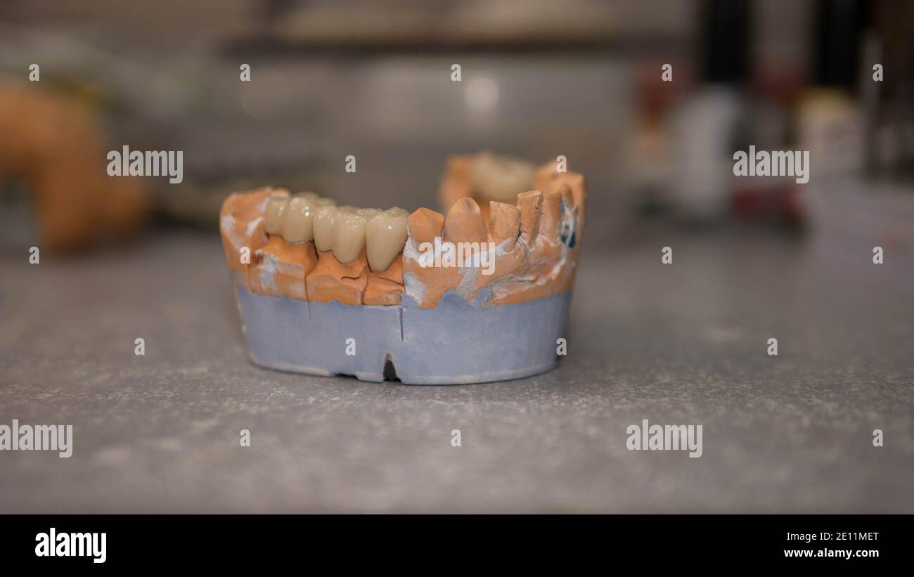 Dental prosthetics,plaster model with false teeth,dental clinic ...