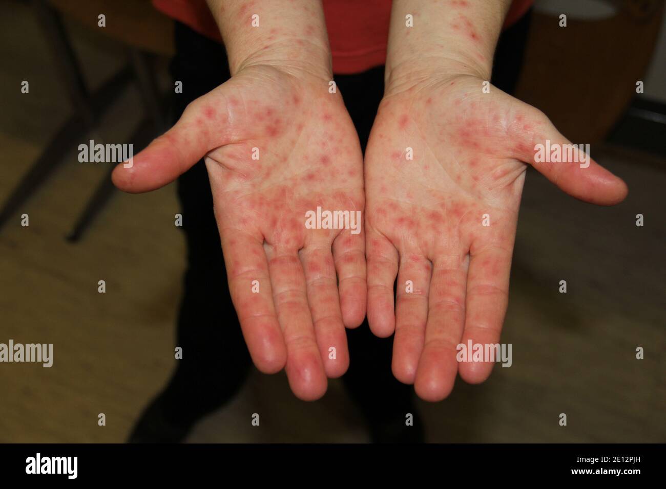 Female Showing Red Pots On Palm Hand Stock Photo - Alamy
