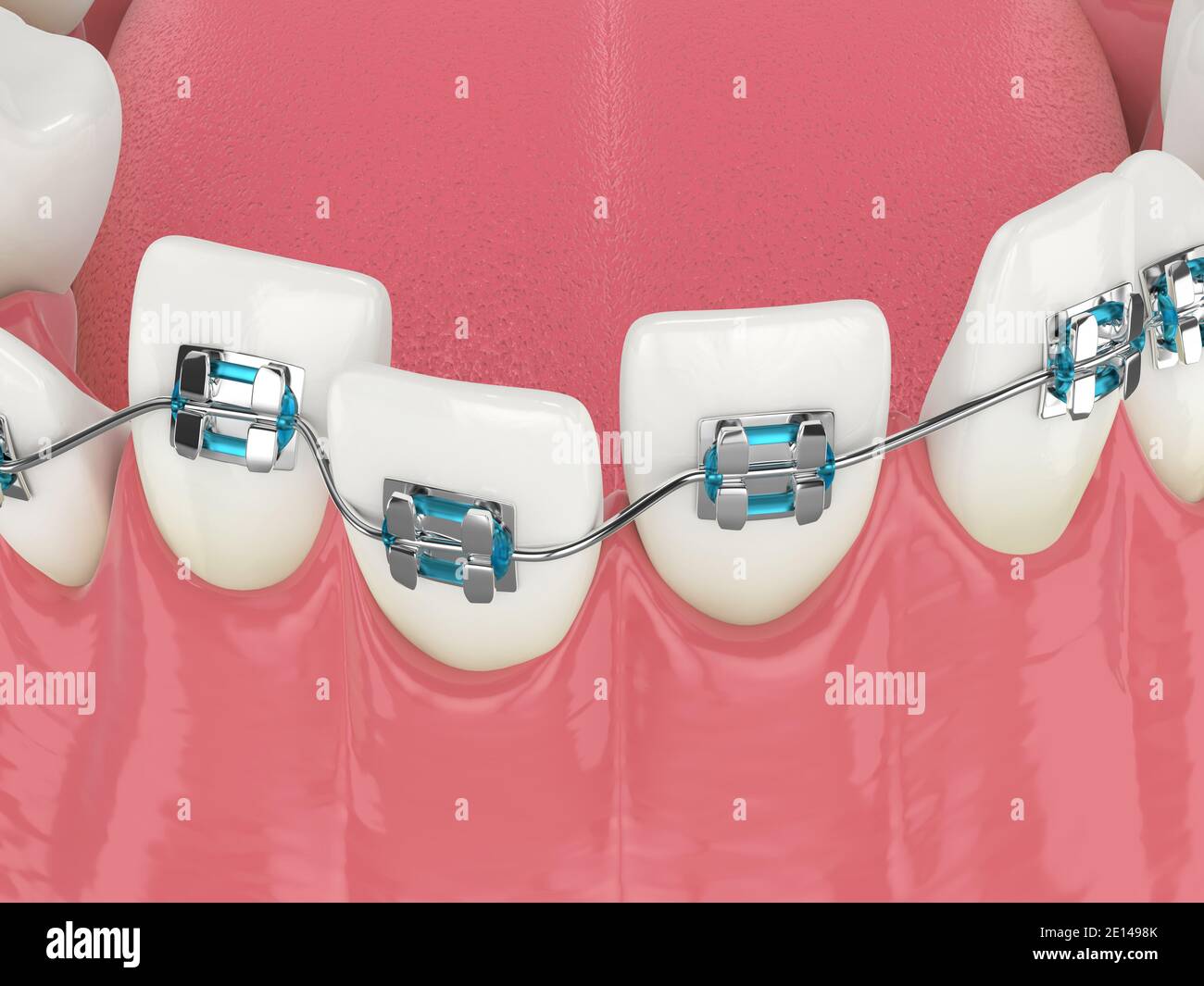 3d render of teeth alignment by orthodontic braces isolated over white ...