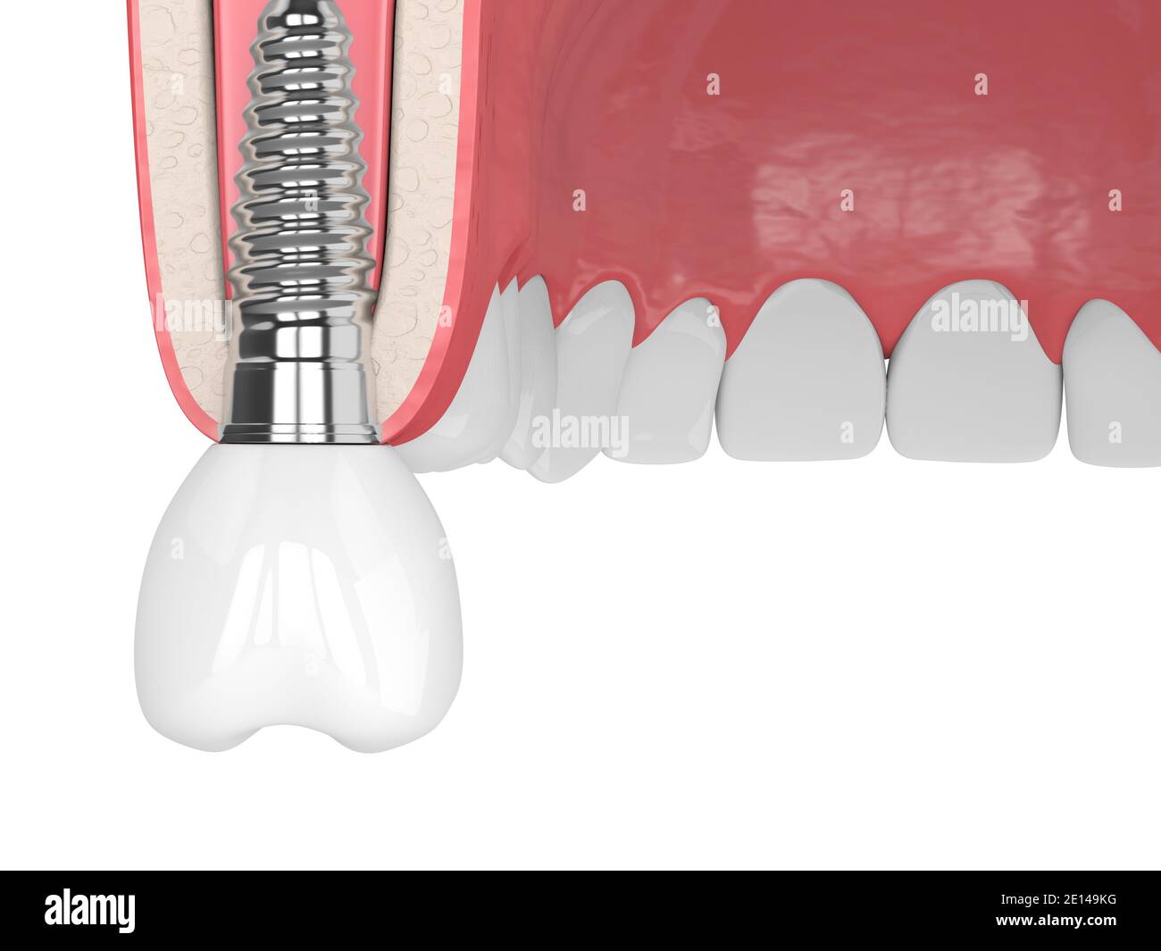 3d render of gum cross-secton with implant placement over white ...