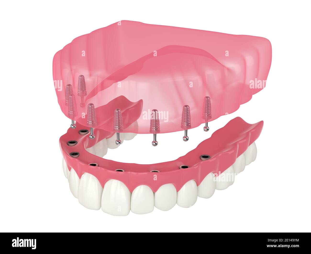 Removable snap on full implant hi-res stock photography and images - Alamy