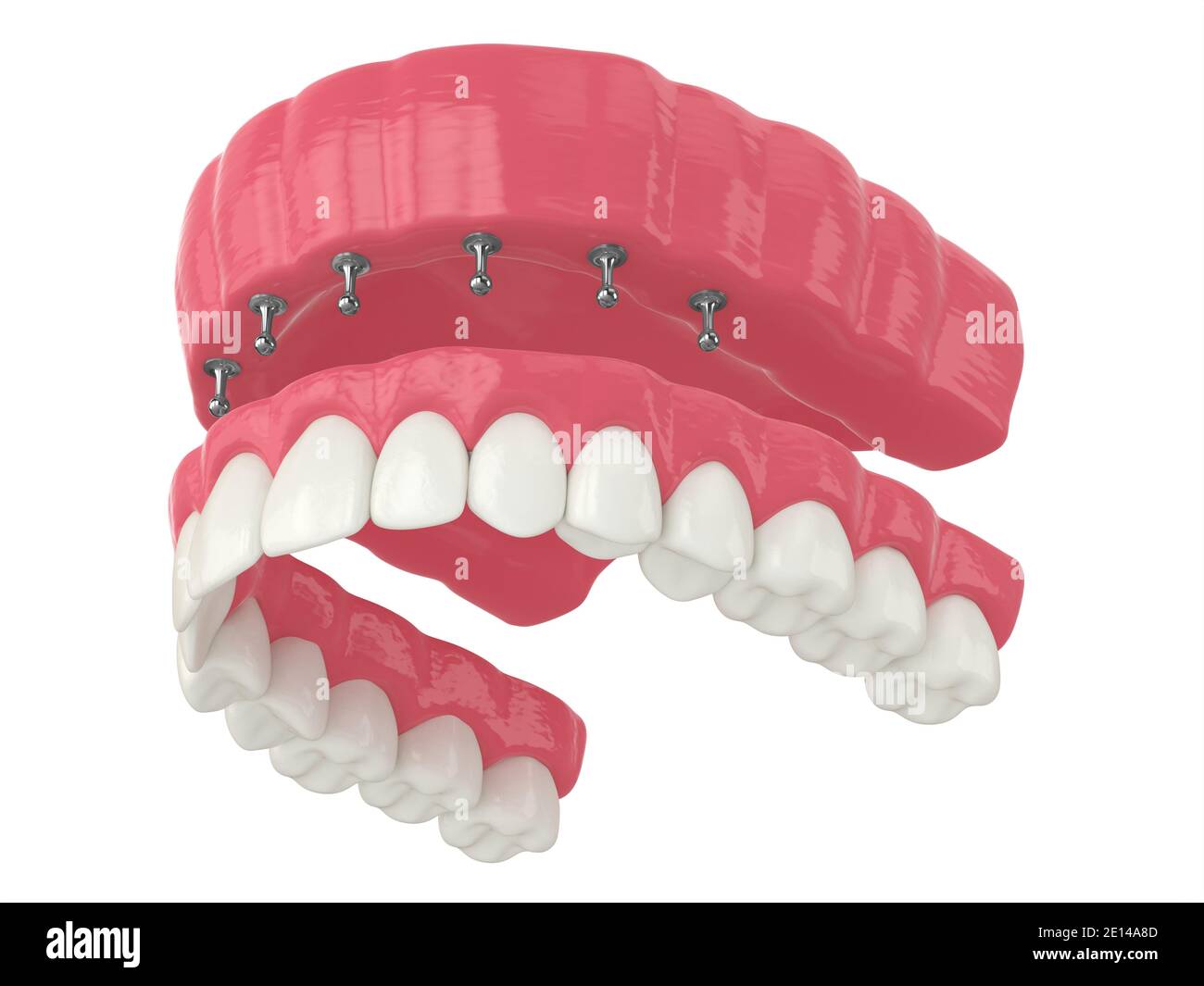3d render of removable snap-on full implant denture installation over ...
