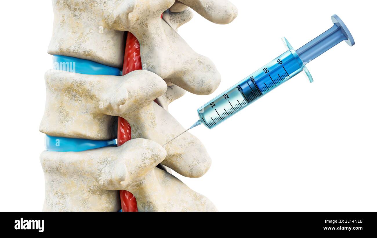 Costovertebral Joint Injection