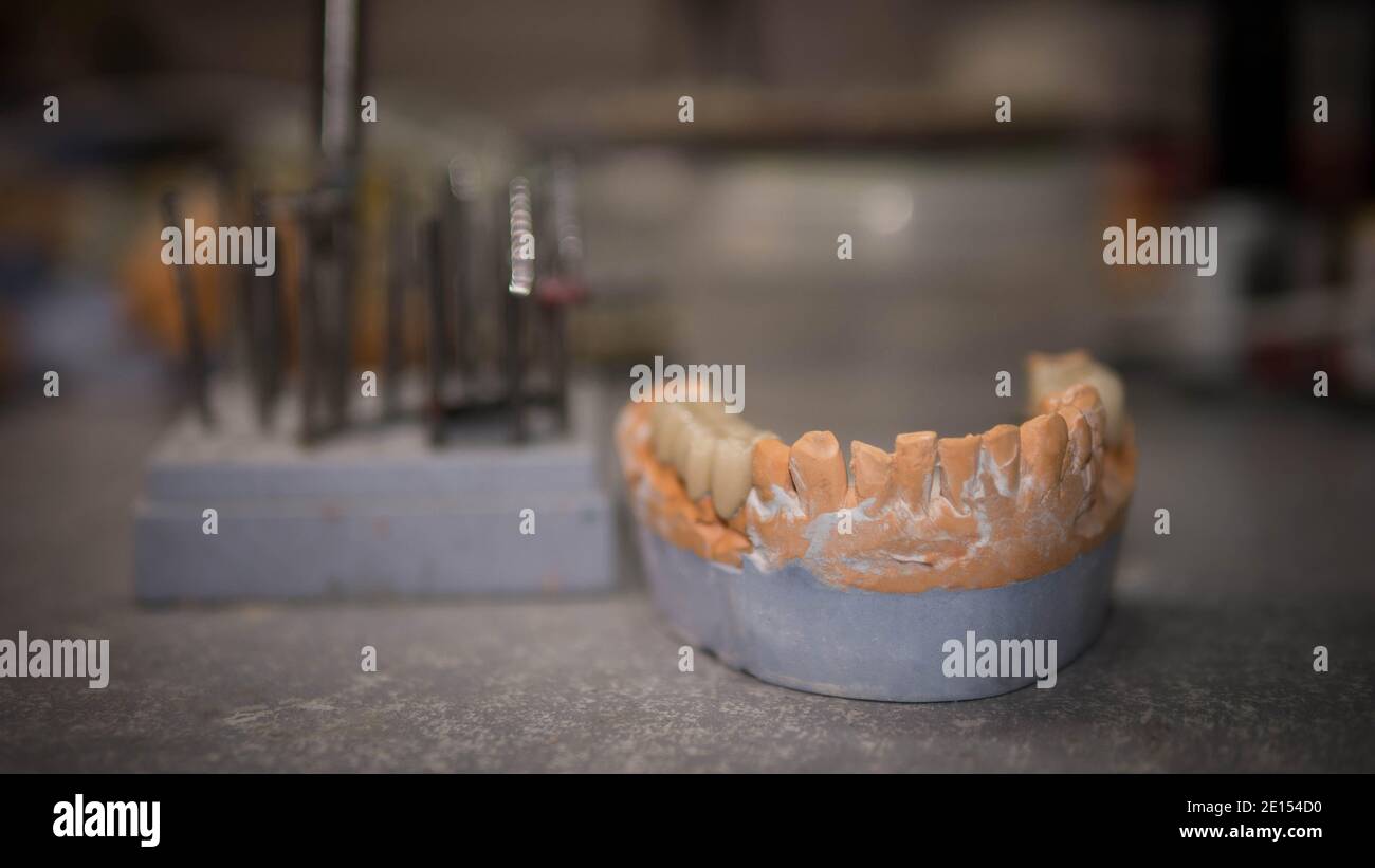 Ceramic crown of a tooth on a plaster model of teeth,the work of a ...