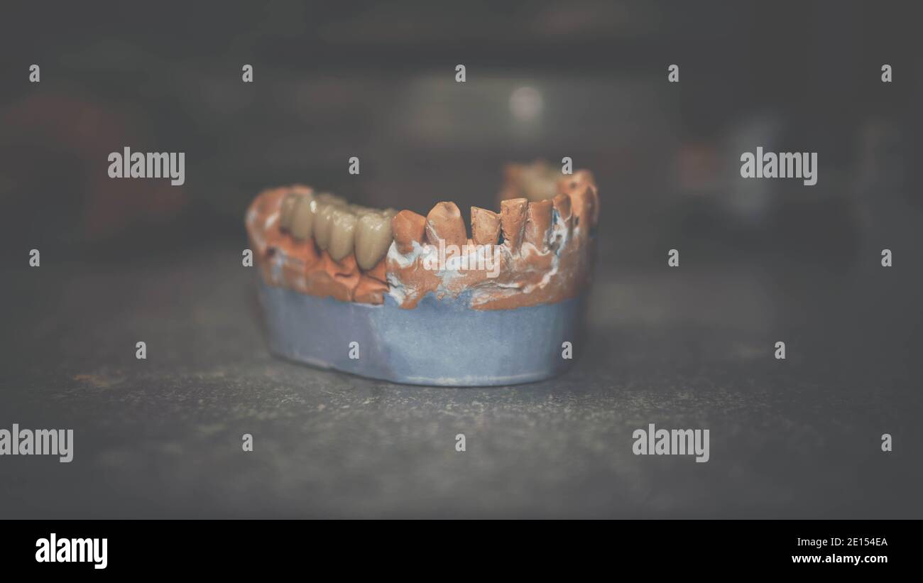 Dental prosthetics,plaster model with false teeth,dental clinic ...