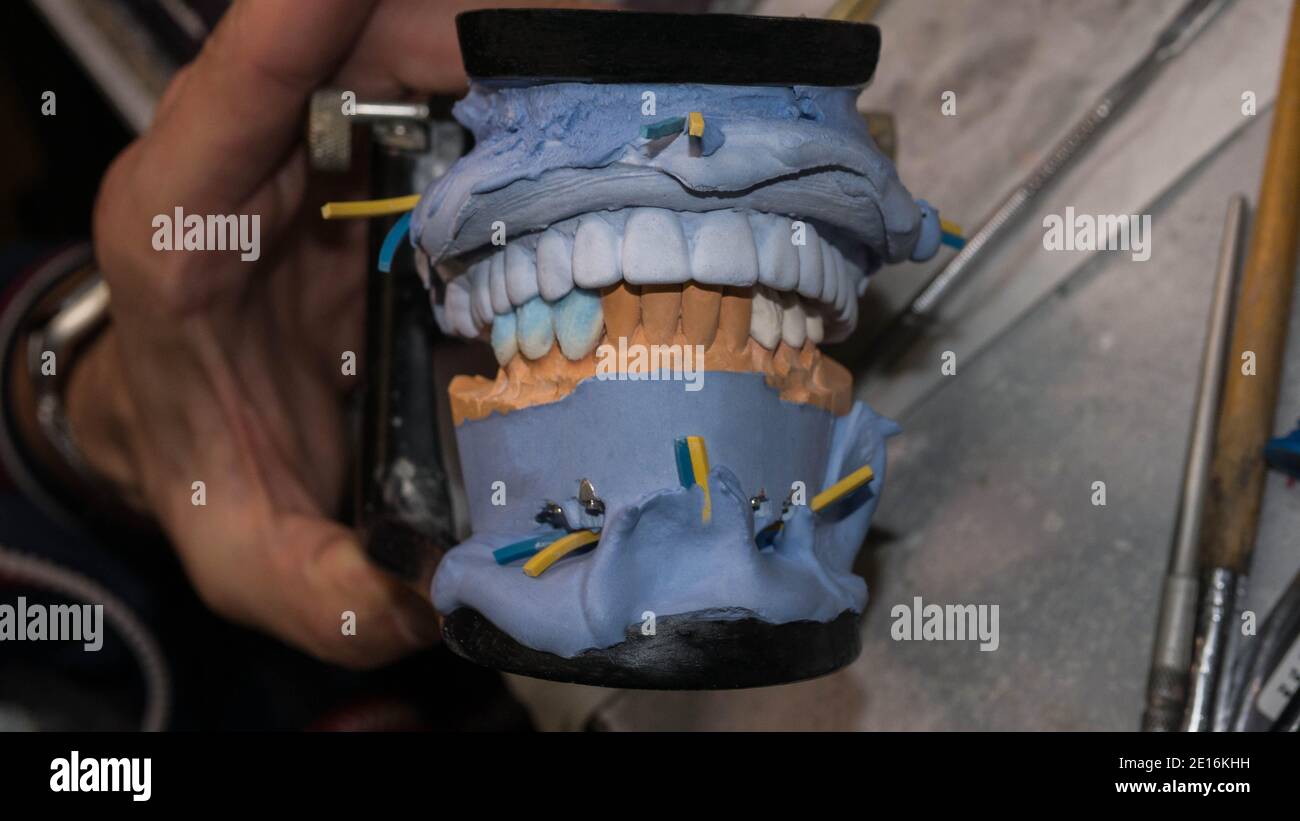 Ceramic crown of a tooth on a plaster model of teeth, the work of a ...