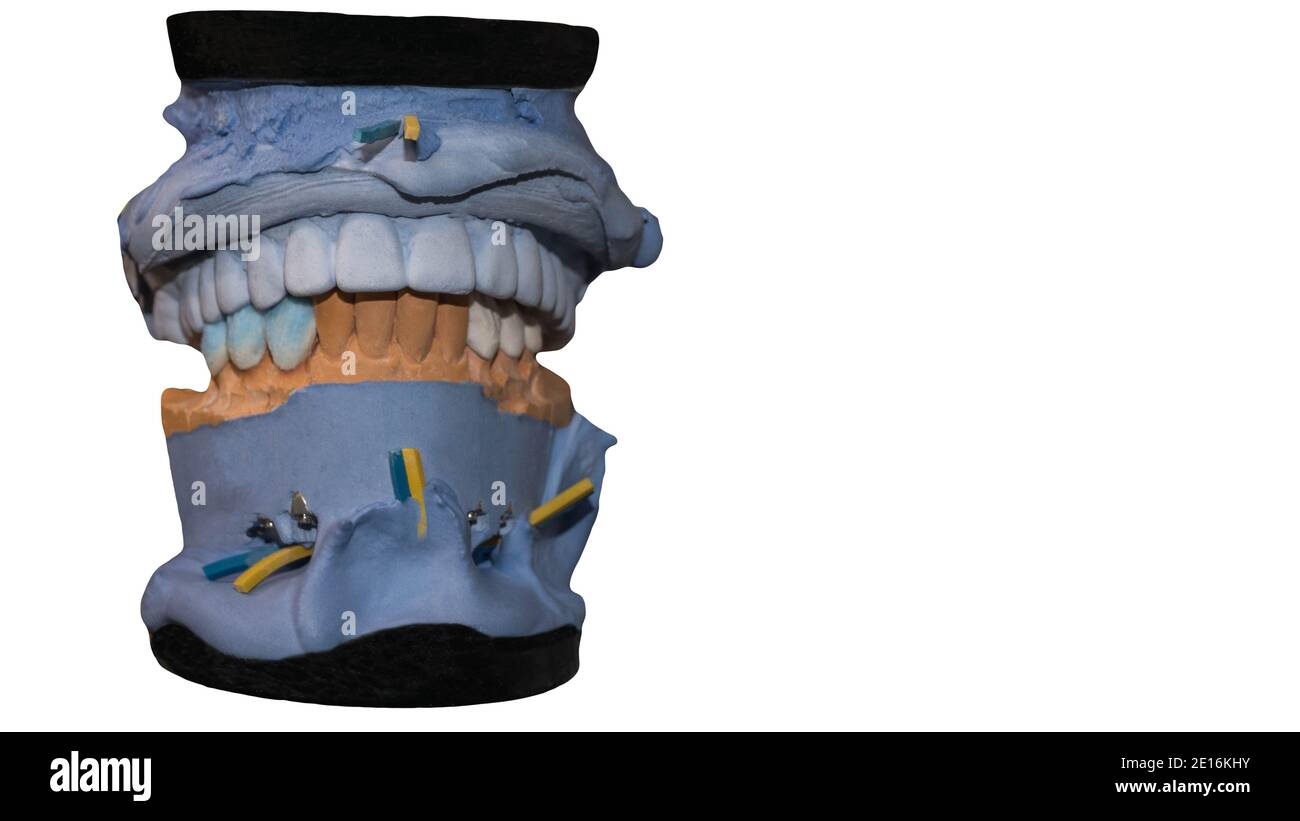 Ceramic crown of a tooth on a plaster model of the teeth is isolated on ...