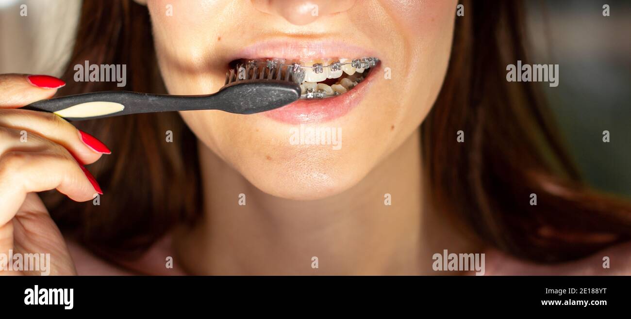brasket system in smiling mouth, macro photo teeth, close-up lips ...