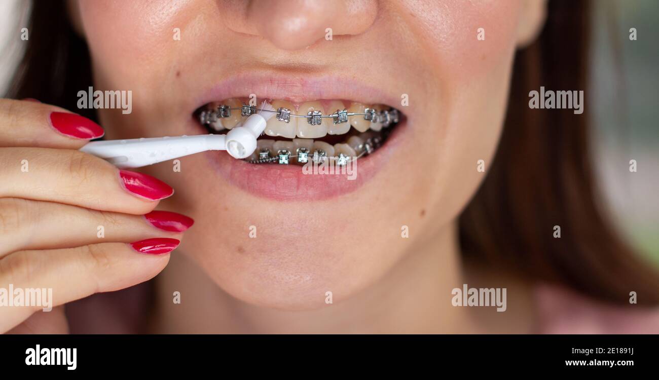 brasket system in smiling mouth, macro photo teeth, close-up lips ...