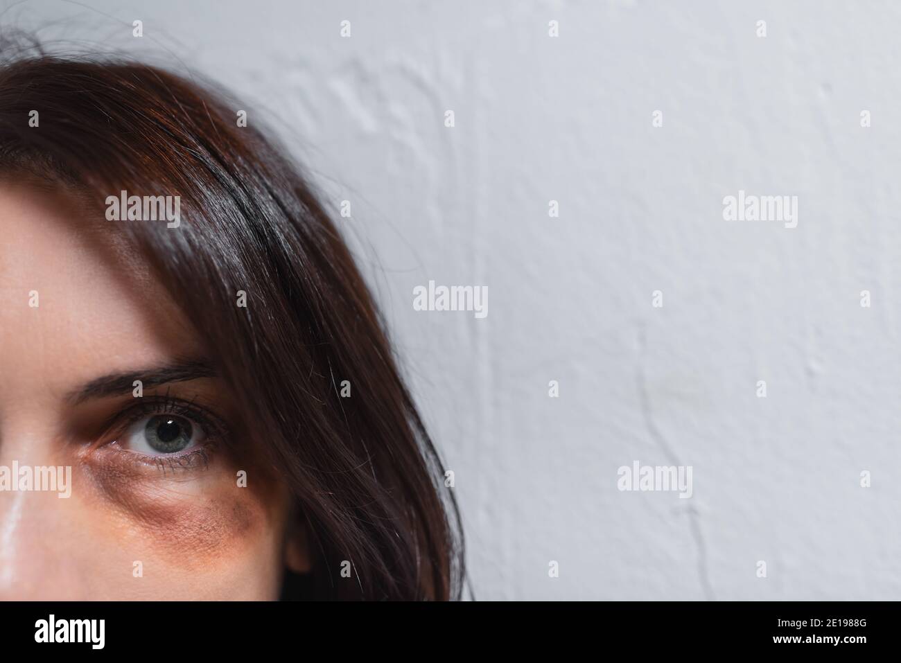 Bruise around eye hi-res stock photography and images - Alamy