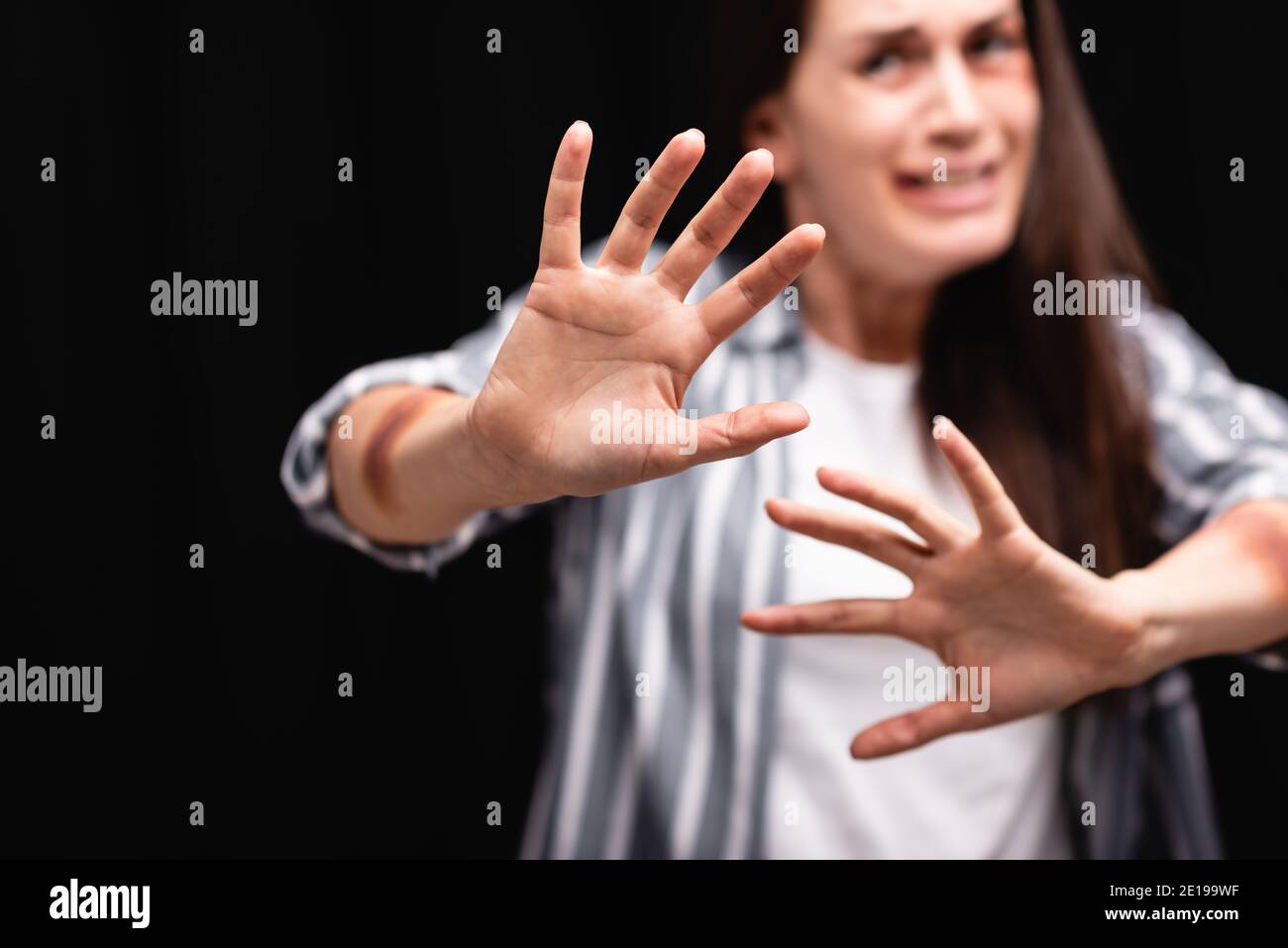 Woman with bruises on hands showing no gesture on blurred background ...