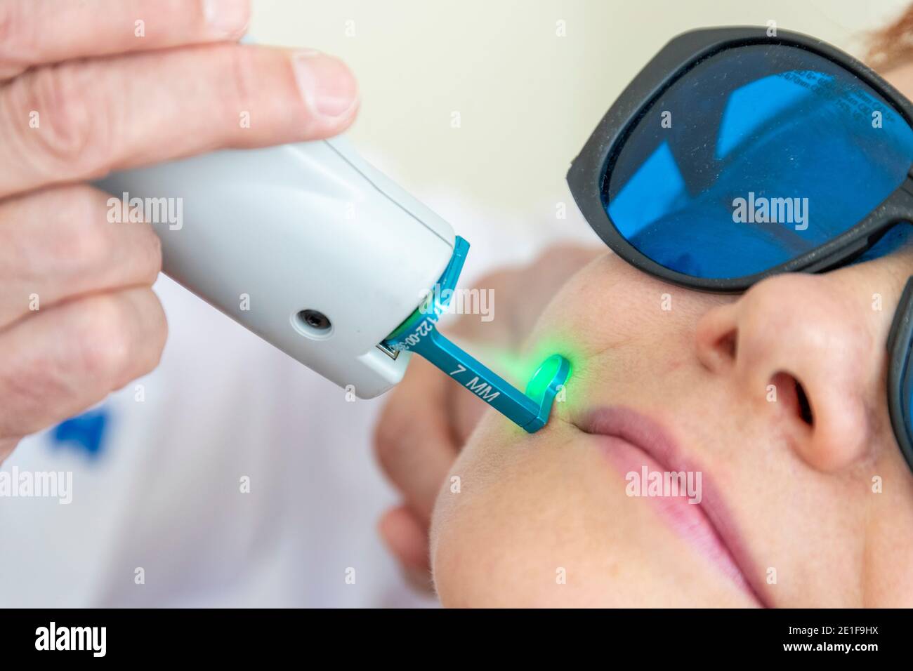 a dermatologist treats a patient's skin with a laser Stock Photo - Alamy