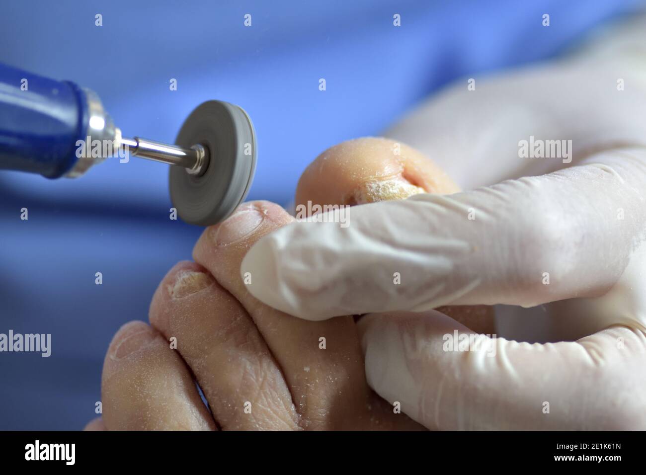 Enfermedad de hongos hi-res stock photography and images - Alamy