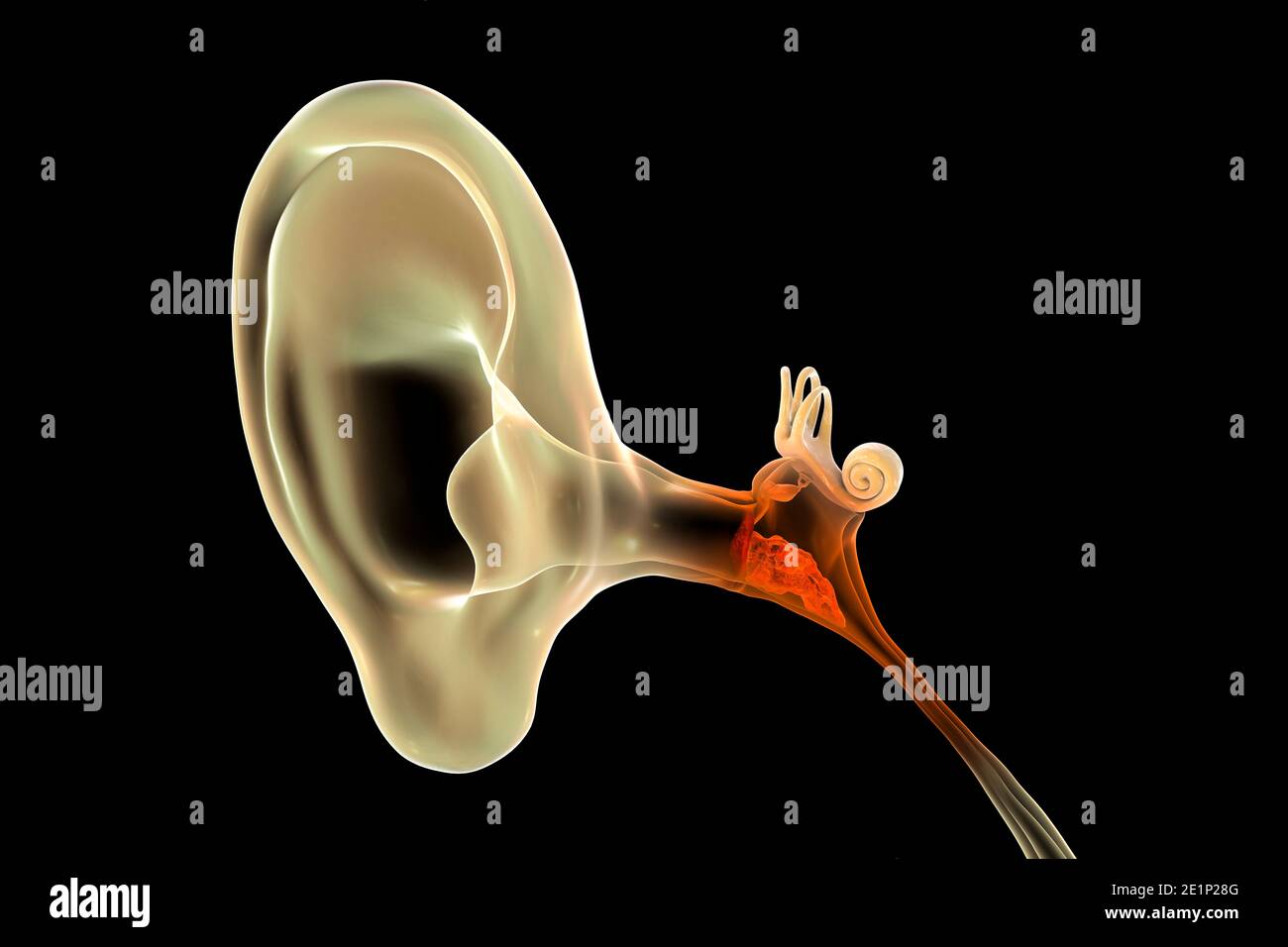 Otitis media ear infection, illustration Stock Photo - Alamy