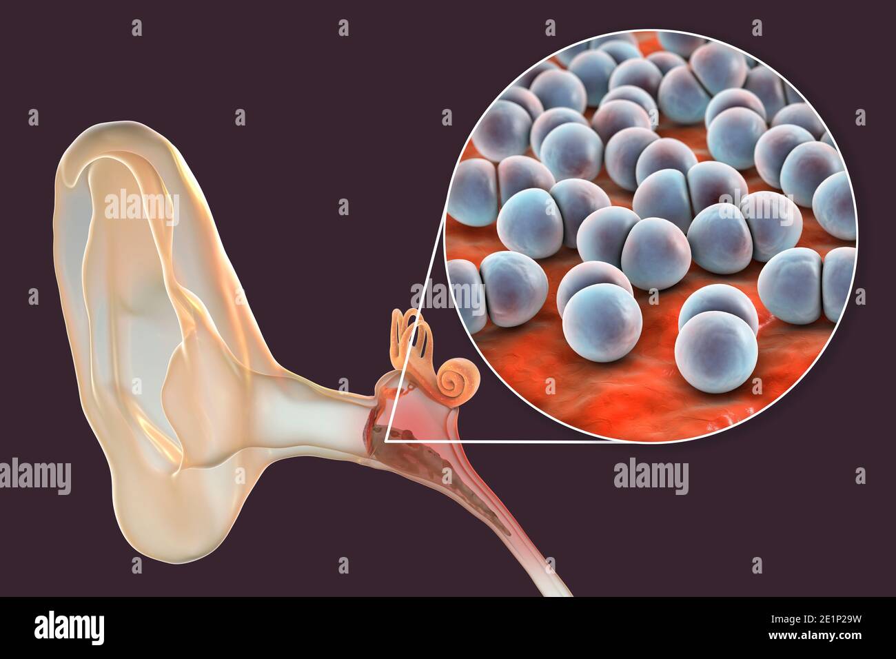 Otitis media ear infection, illustration Stock Photo - Alamy