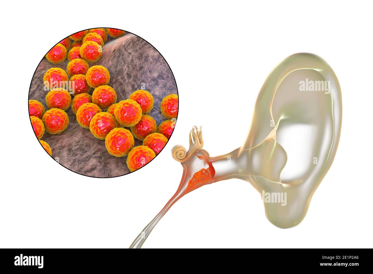 Ear drum infection Cut Out Stock Images & Pictures - Alamy