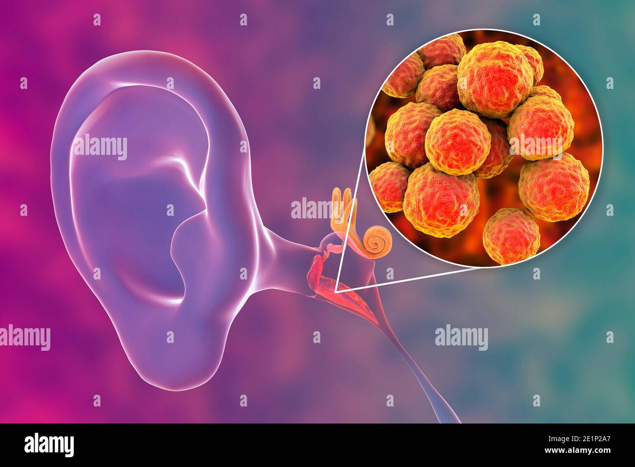 Otitis media ear infection, illustration Stock Photo - Alamy