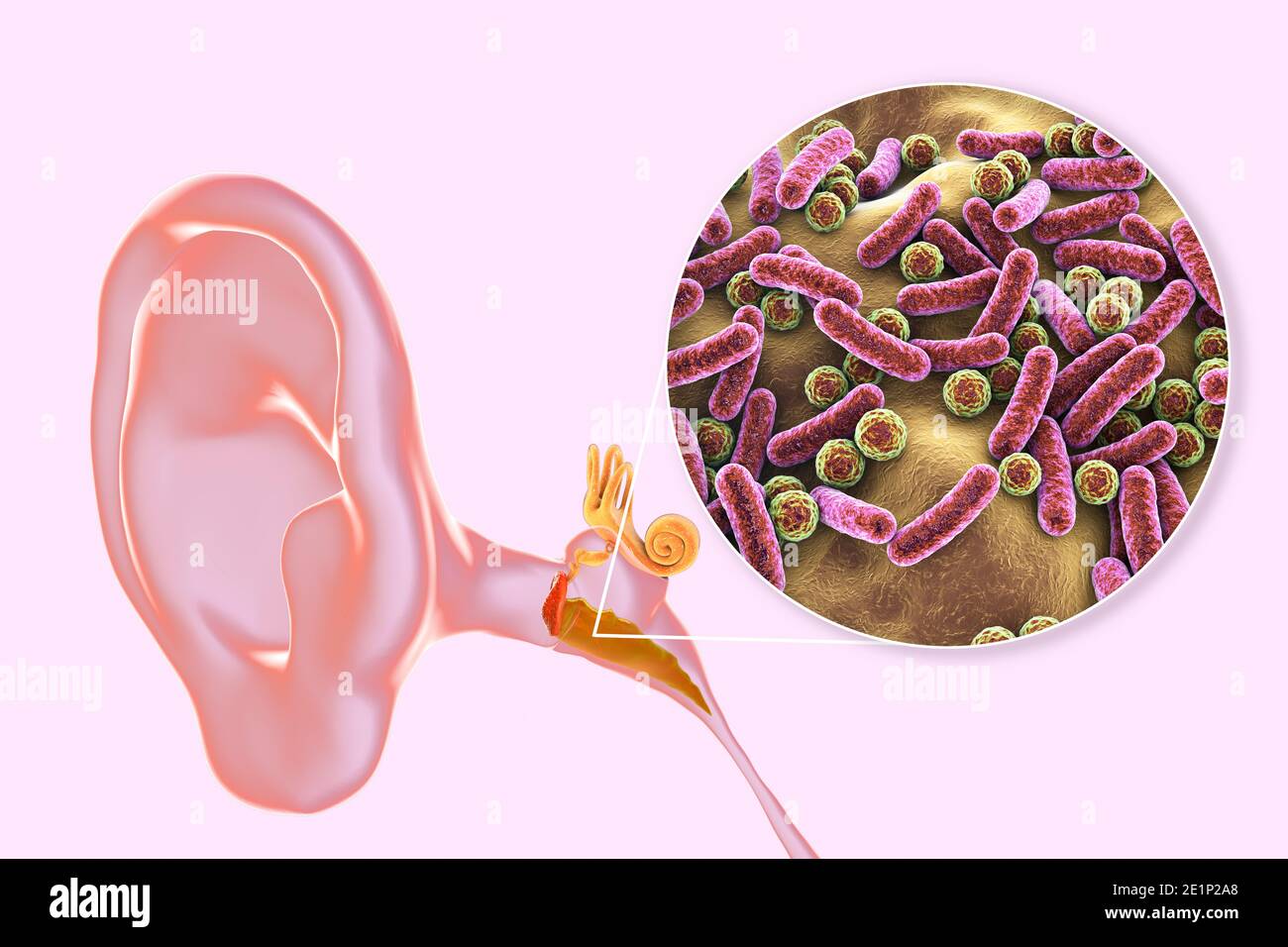 Otitis media ear infection, illustration Stock Photo - Alamy