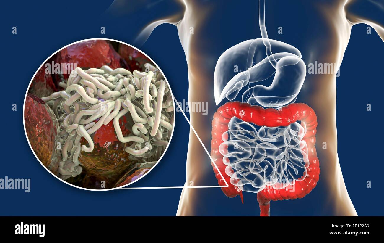 Round worms in human large intestine, illustration Stock Photo - Alamy