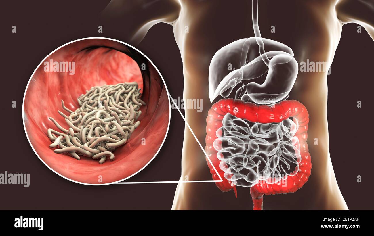 Round worms in human large intestine, illustration Stock Photo - Alamy