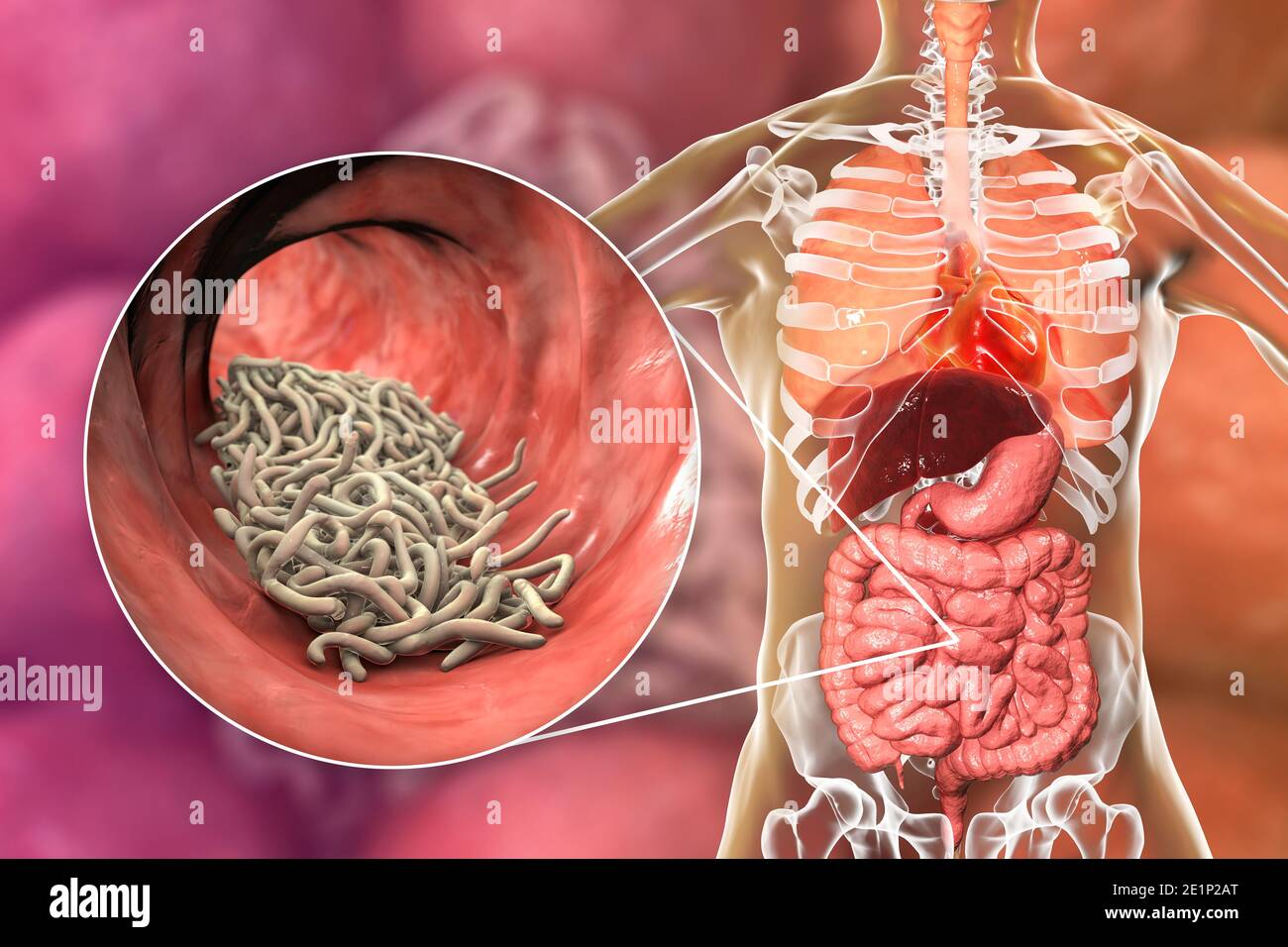 Round worms in human intestine, illustration Stock Photo - Alamy