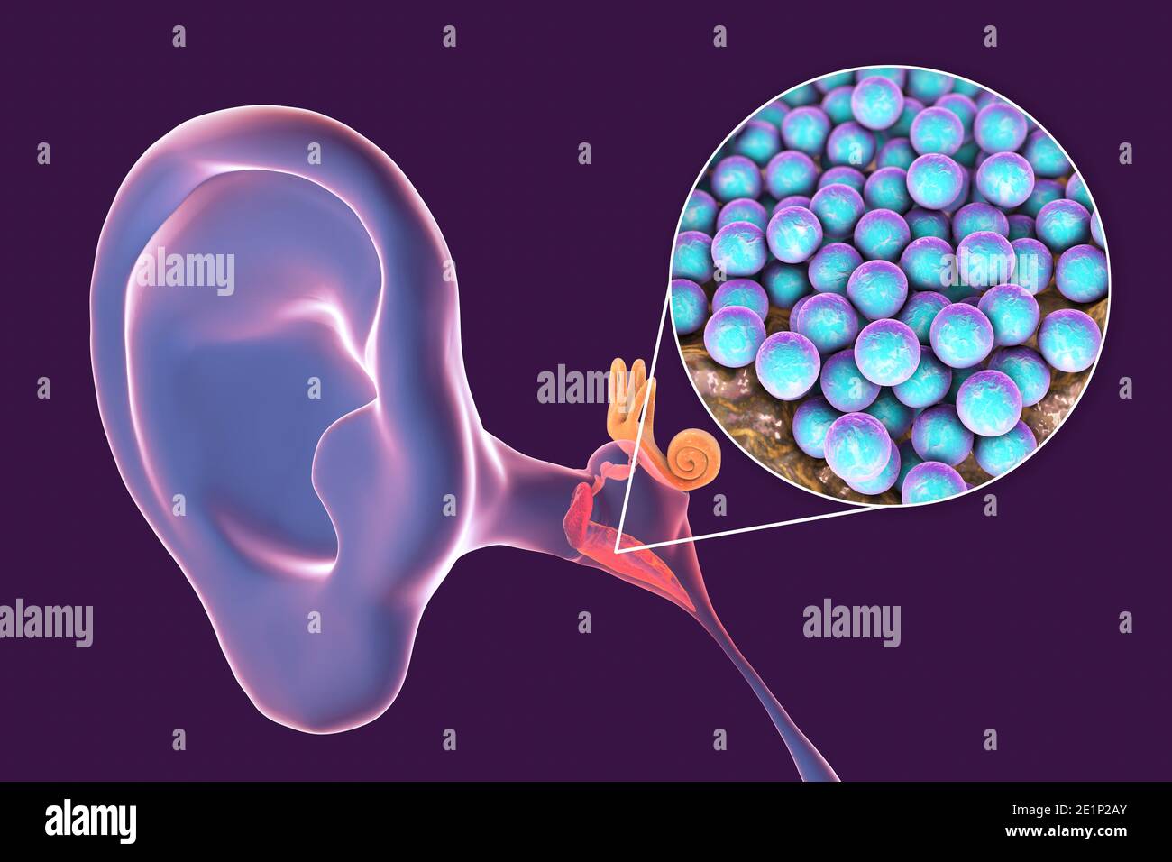 Otitis media ear infection, illustration Stock Photo - Alamy