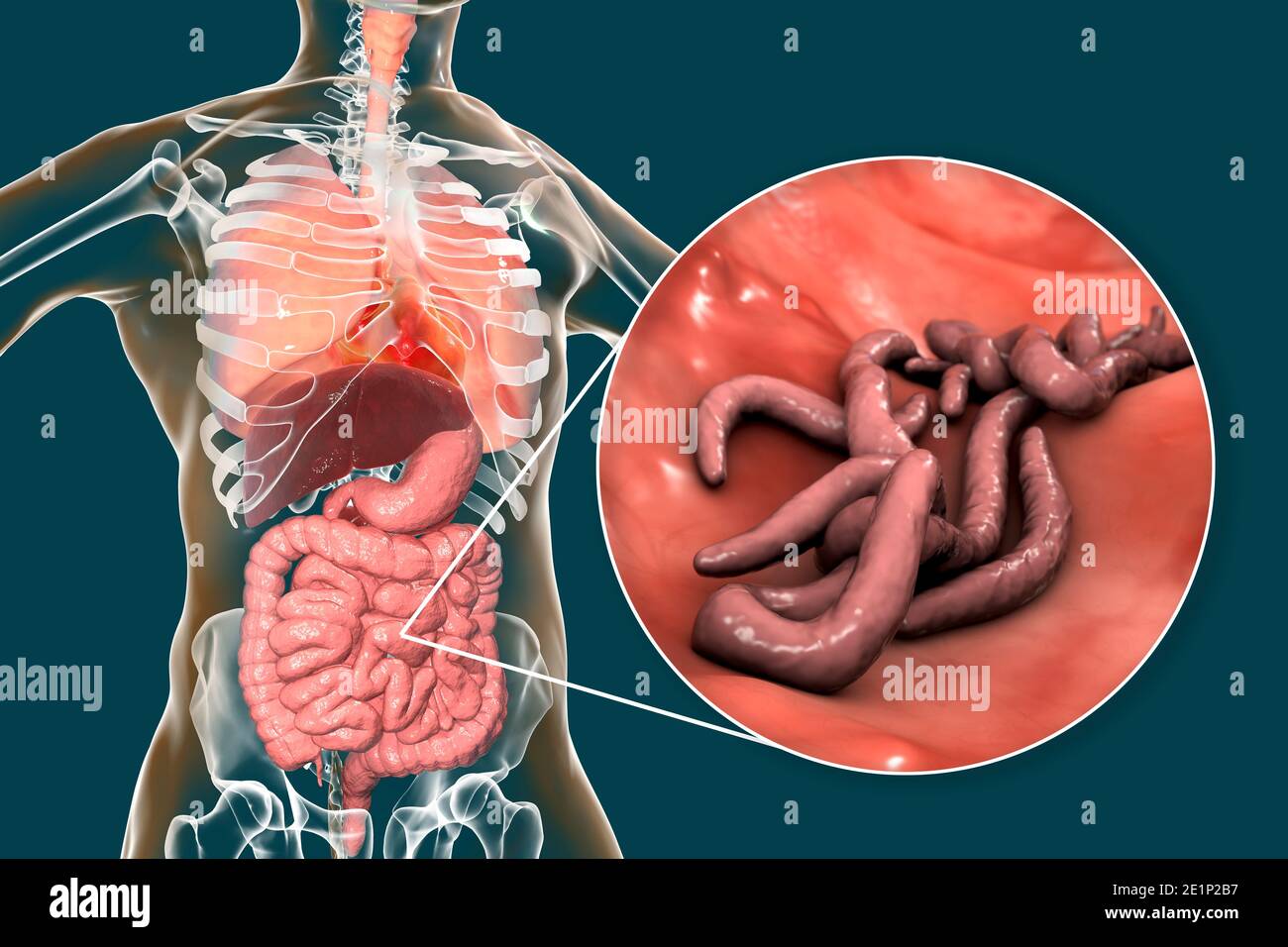 Round worms in human intestine, illustration Stock Photo - Alamy