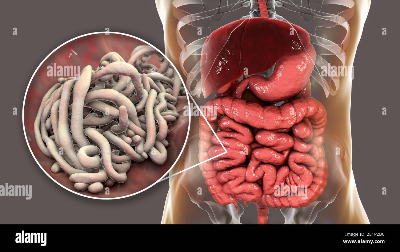 Round worms in human intestine, illustration Stock Photo - Alamy