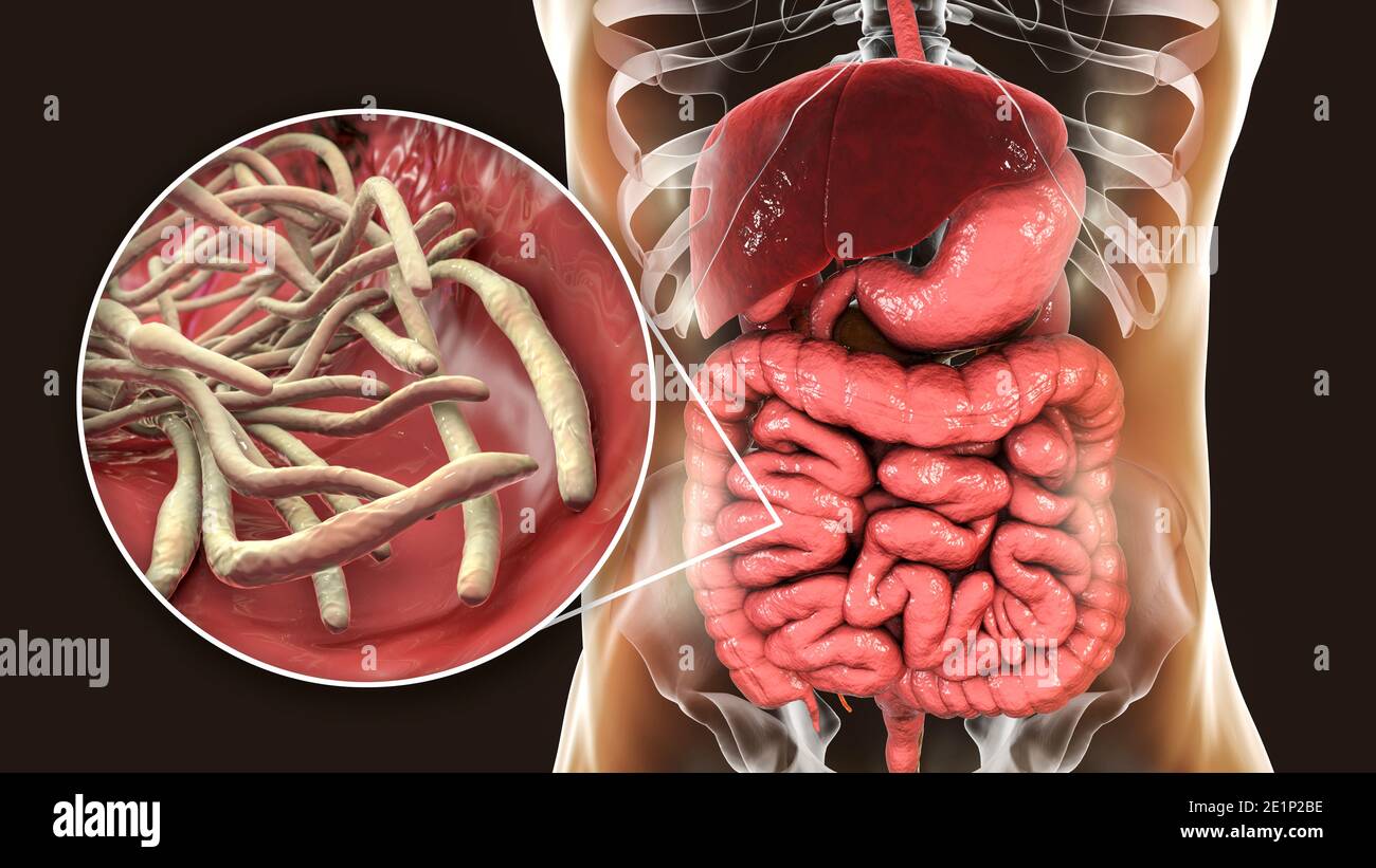 Round worms in human intestine, illustration Stock Photo - Alamy