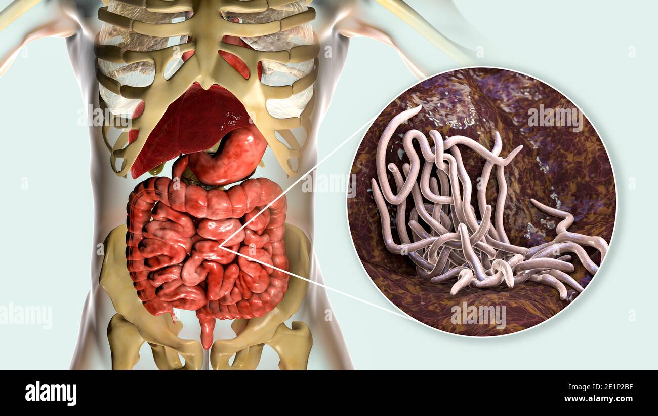 Round worms in human intestine, illustration Stock Photo - Alamy