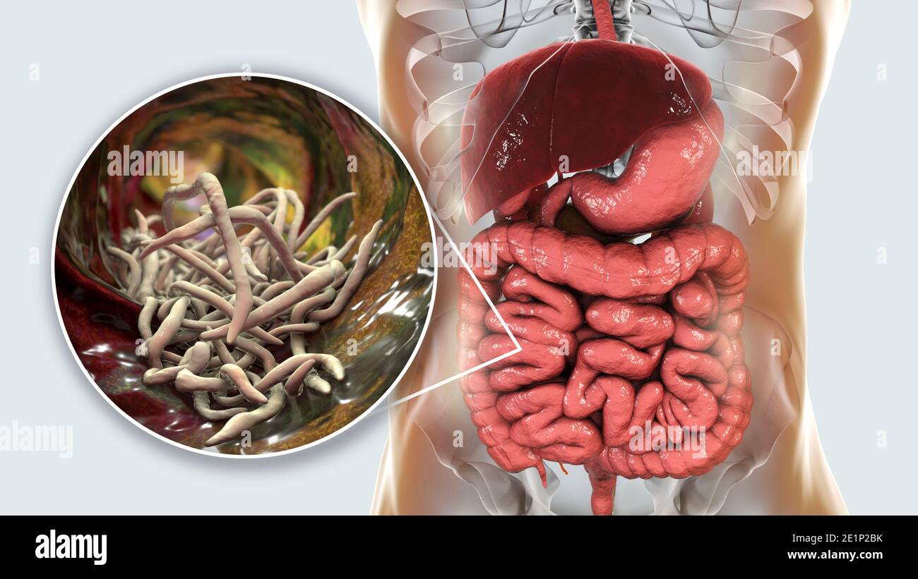 Round worms in human intestine, illustration Stock Photo - Alamy