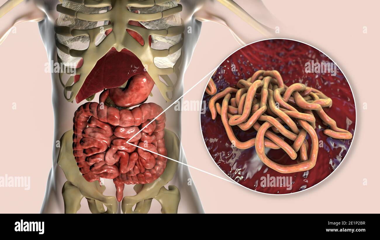 Round worms in human intestine, illustration Stock Photo - Alamy