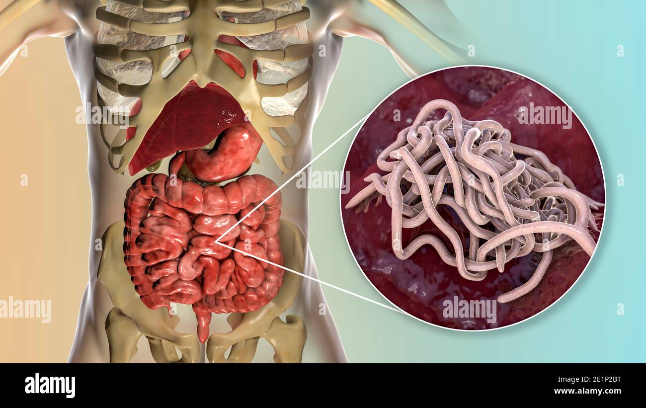 Round worms in human intestine, illustration Stock Photo - Alamy