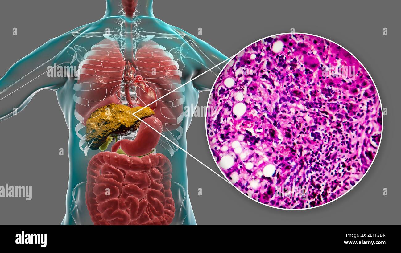 Liver cirrhosis, illustration and light micrograph Stock Photo - Alamy