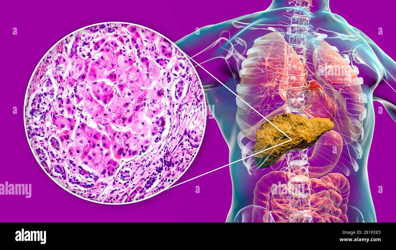 Liver Disease Cells High Resolution Stock Photography and Images - Alamy
