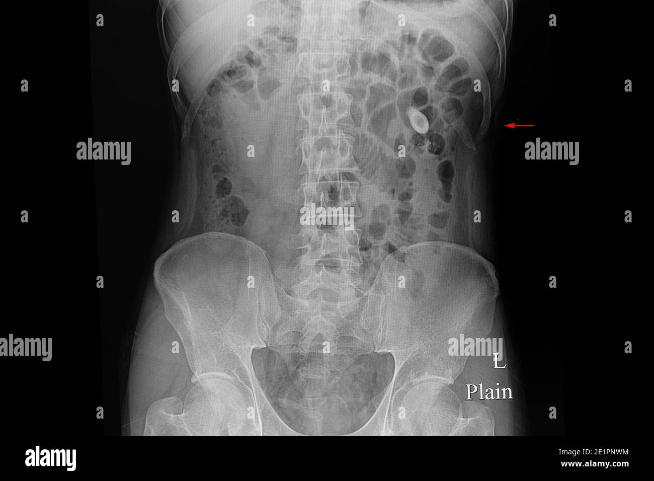 Gallbladder Stones Xray