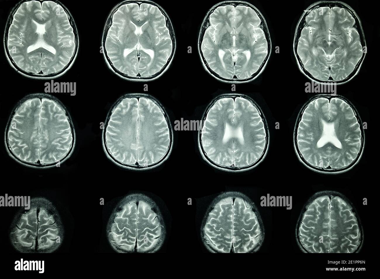 Mri scan of brain hi-res stock photography and images - Alamy