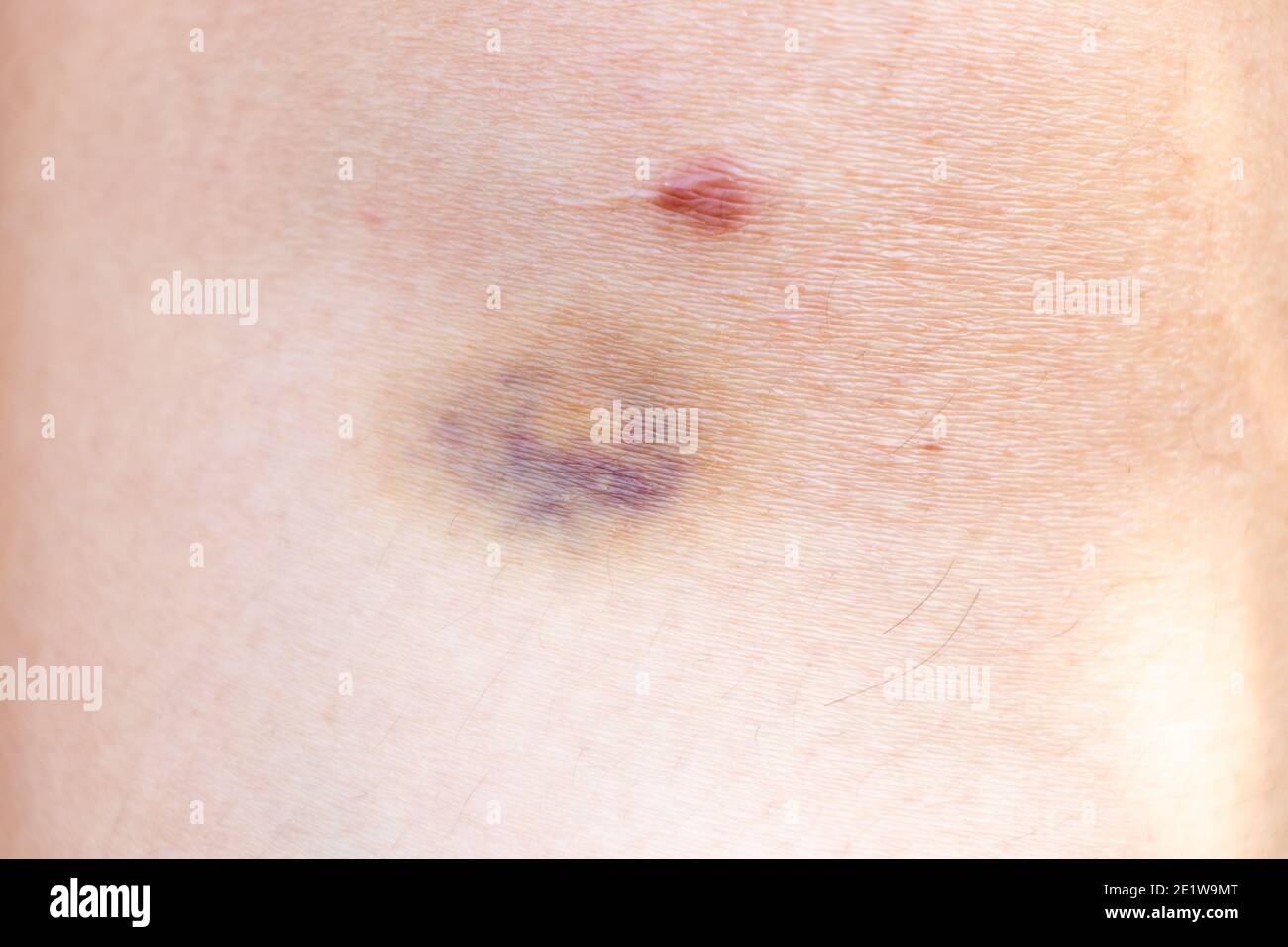 Closed up background of violet lesion on asian woman skin Stock Photo ...