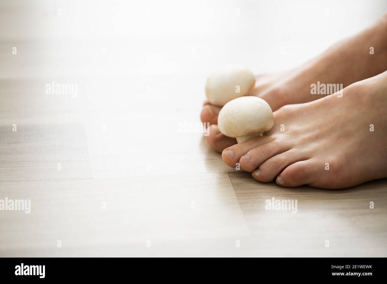 Fungus Mushroom Between Toenail. Smelly Feet And Fungi Stock Photo - Alamy